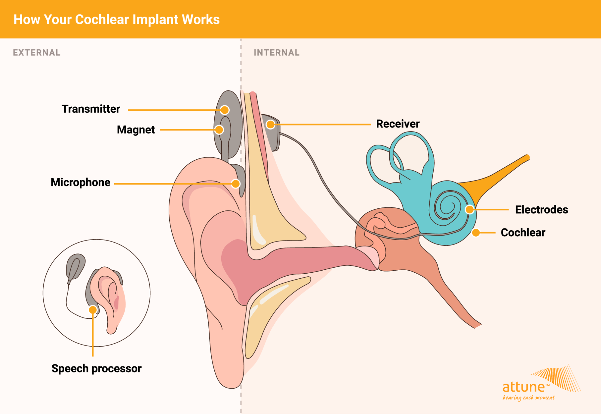 What Are Cochlear Implants Attune