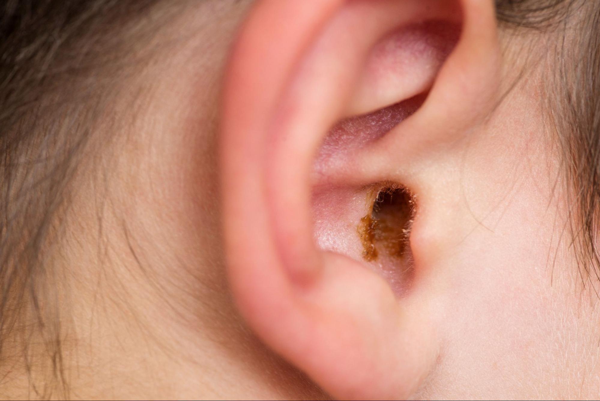 How To Safely Remove Earwax From Your Ears Attune How To Safely Remove Earwax From Your Ears Attune